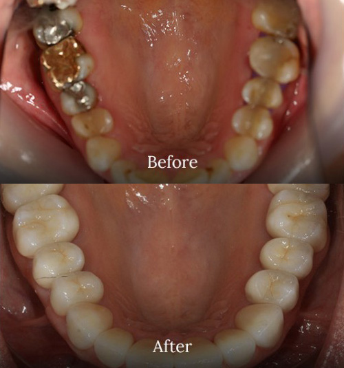 Smile Gallery - Real Patient Smiles | Shore Dental